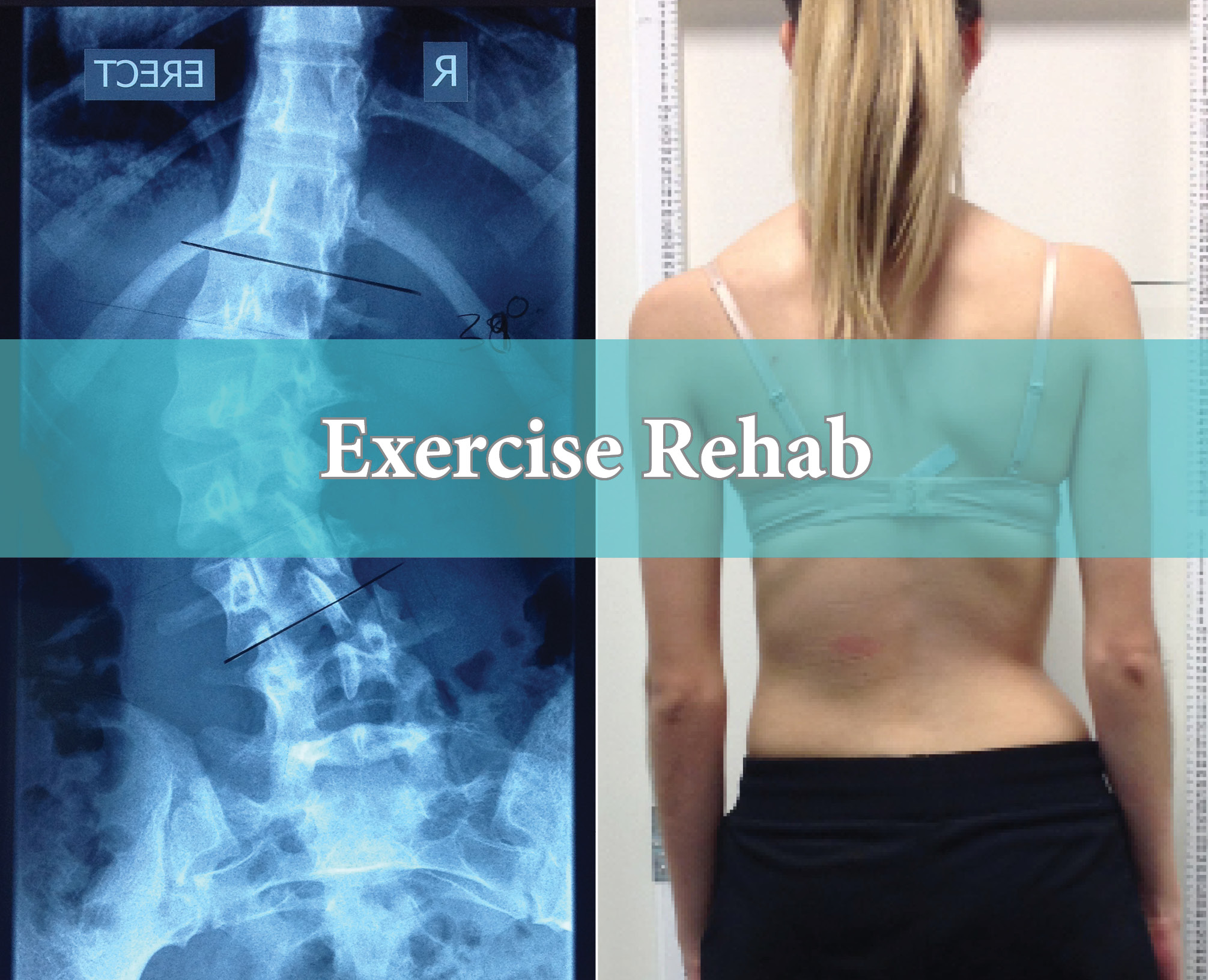 Case – Exercise Rehabilitation